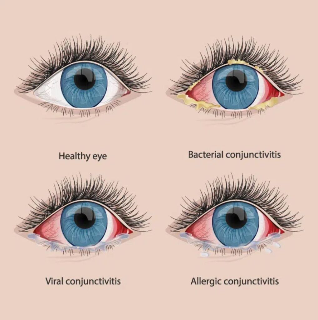 Demystifying Conjunctivitis: Causes, Symptoms, Prevention and Treatment - svision